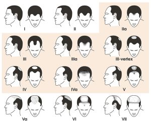 Hairline Transplant: Everything You Need to Know