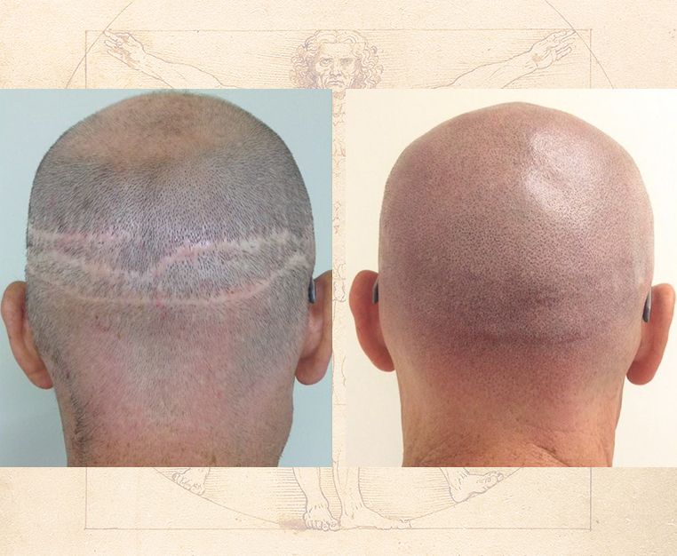 What Can Ruin A Hair Transplant? - Vinci Hair Clinic