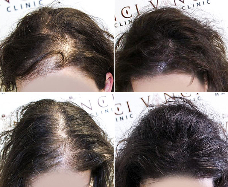 How Micro Scalp Pigmentation Can Help With Thinning Hair - Here's ...